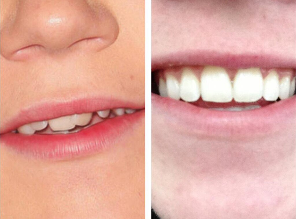 1D s Niall Horan Gets His Braces Off See Before After