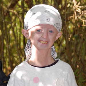 Hayley Okines Dies at 17; Progeria Campaigner Charmed Prince Charles ...