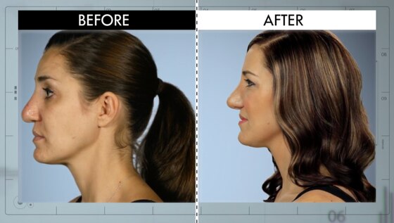 See the Shocking Botched Before and Afters! | E! News