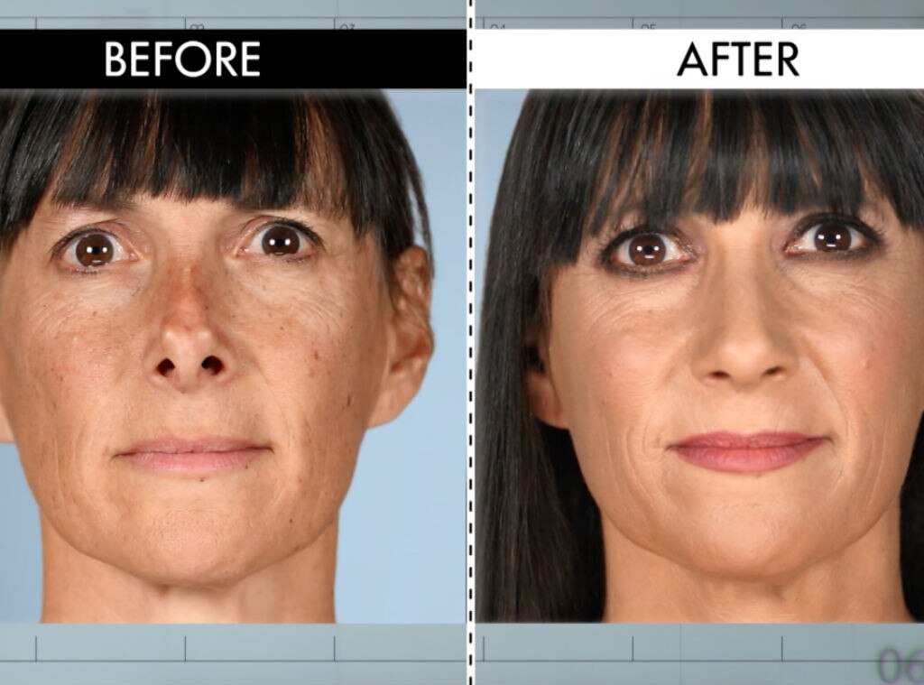 Botched Surgery Pictures Before And After