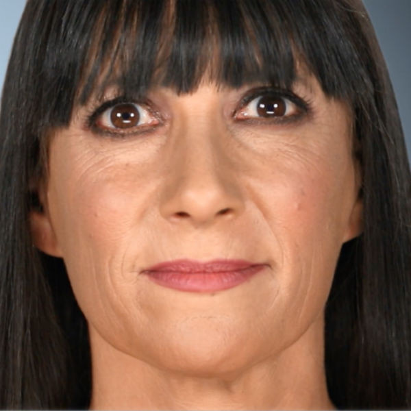 Botched Patient's Nose Is ''Reborn'' Without ''Horns''