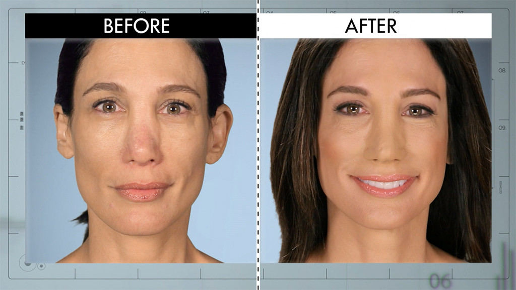 14 Rhinoplasties Later... from Botched Patients Before and After ...