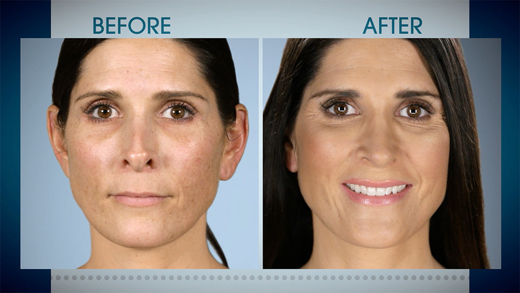 Photos from Botched Patients Before and After: Shocking Transformations ...