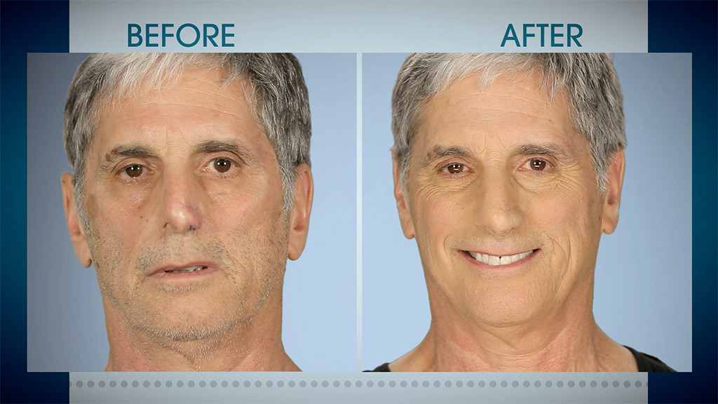 Photos from Botched Patients Before and After: Shocking Transformations ...