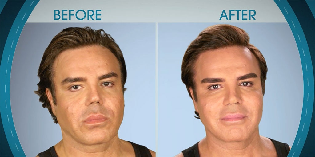 Baklava Beak from Botched Patients Before and After: Shocking ...