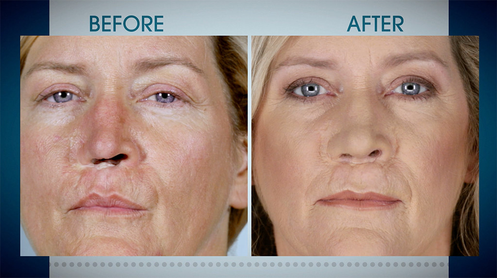 Photos from Botched Patients Before and After: Shocking Transformations ...