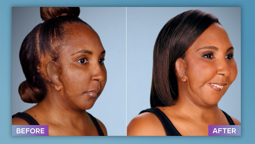 Photos from Botched Patients Before and After: Shocking Transformations!
